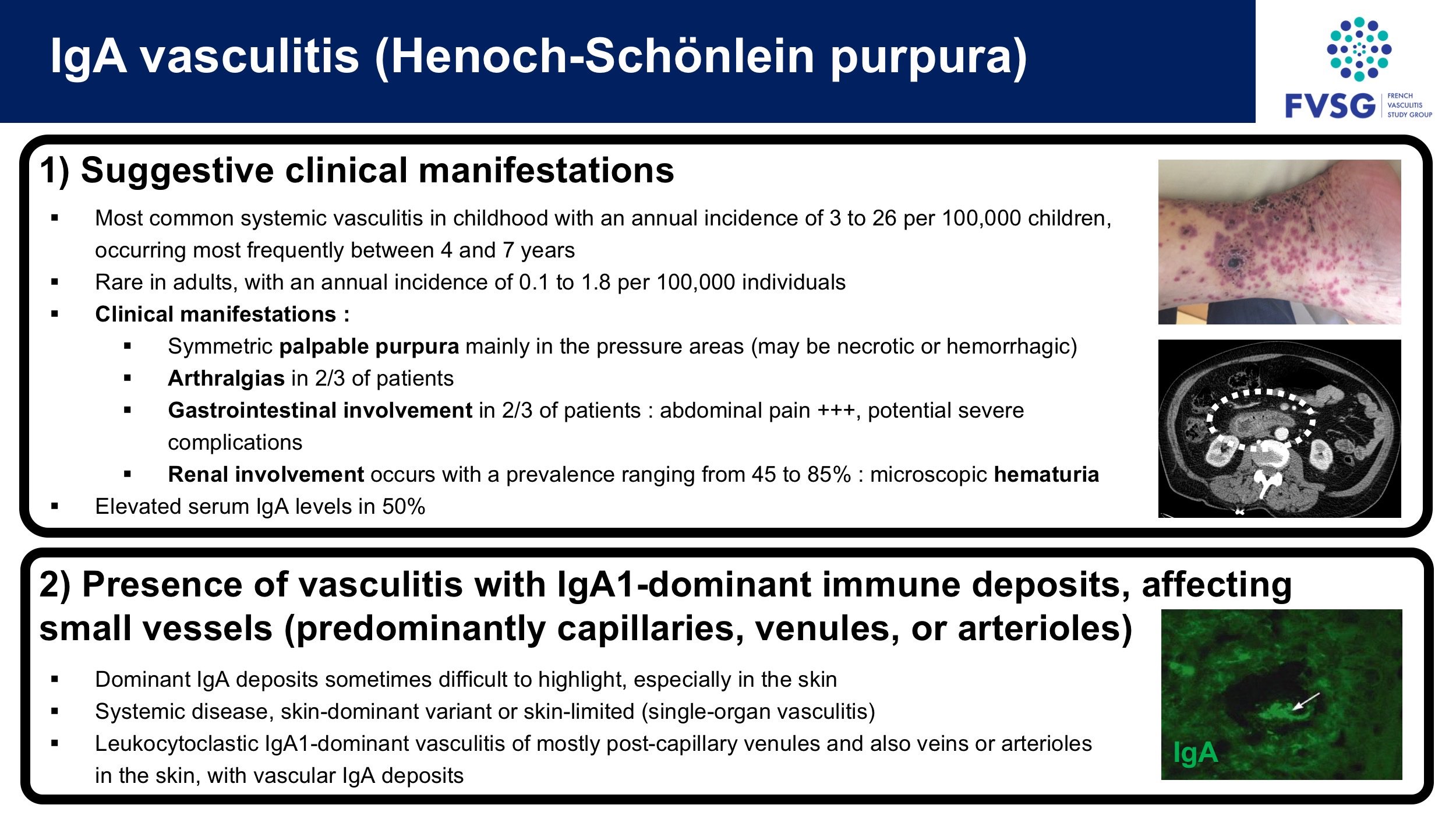 Henoch Schonlein Purpura In Adults