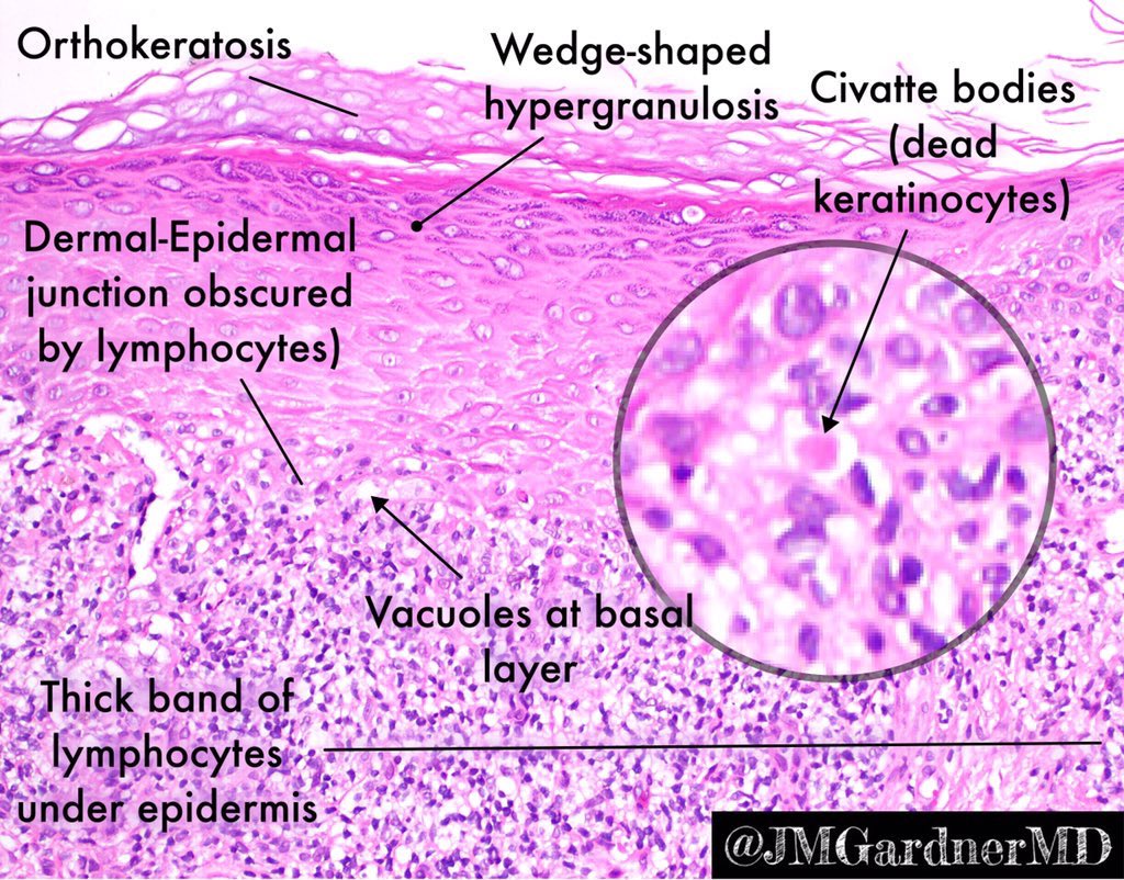 Lichen Planus Histology Civatte Body