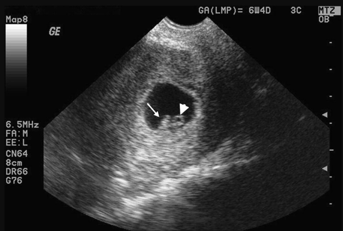 Human Yolk Sac Ultrasound