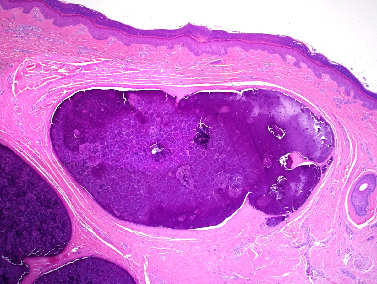 Calcinosis Cutis Histopathology