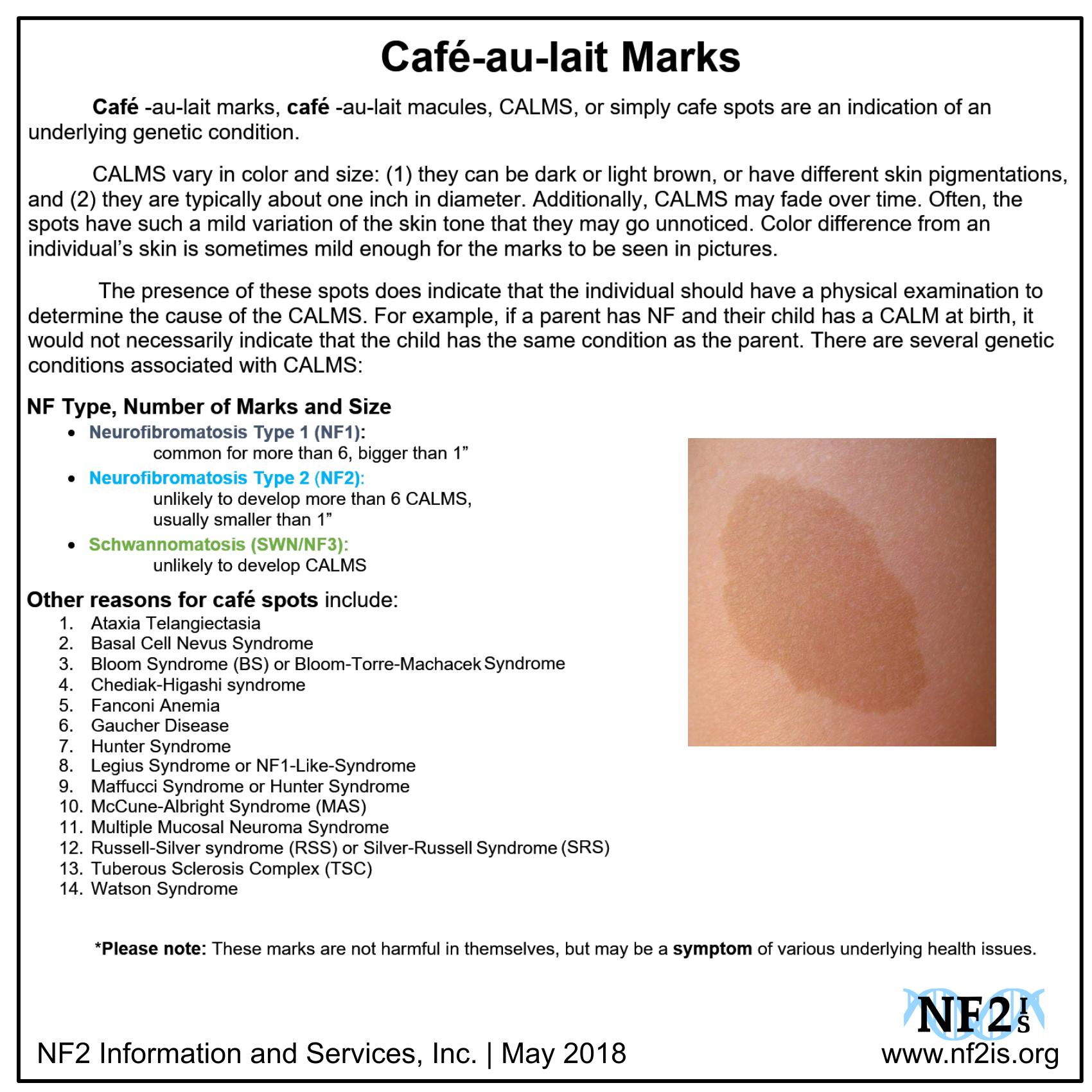Cafe Au Lait Neurofibromatosis