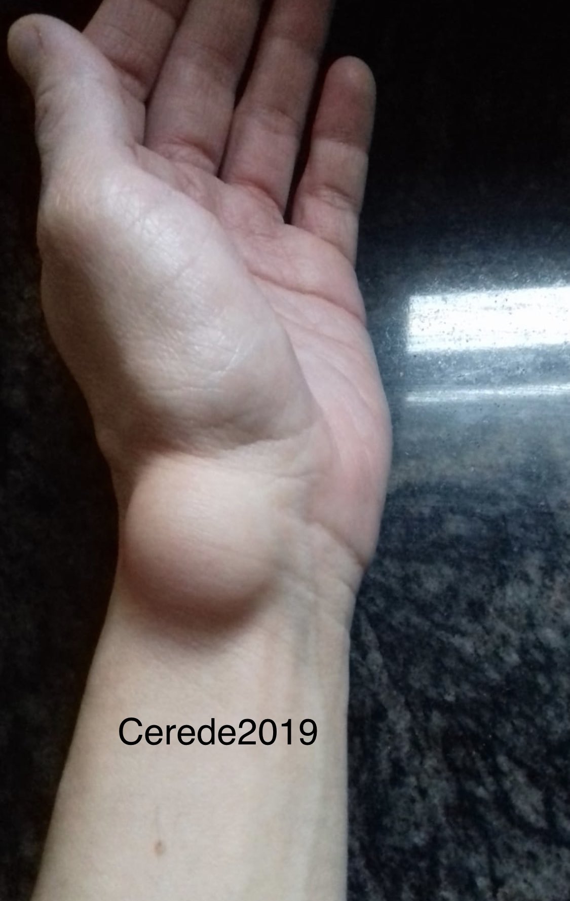 preocupación escritura tormenta tratamiento para ganglion de muñeca Factibilidad acumular tengo ...