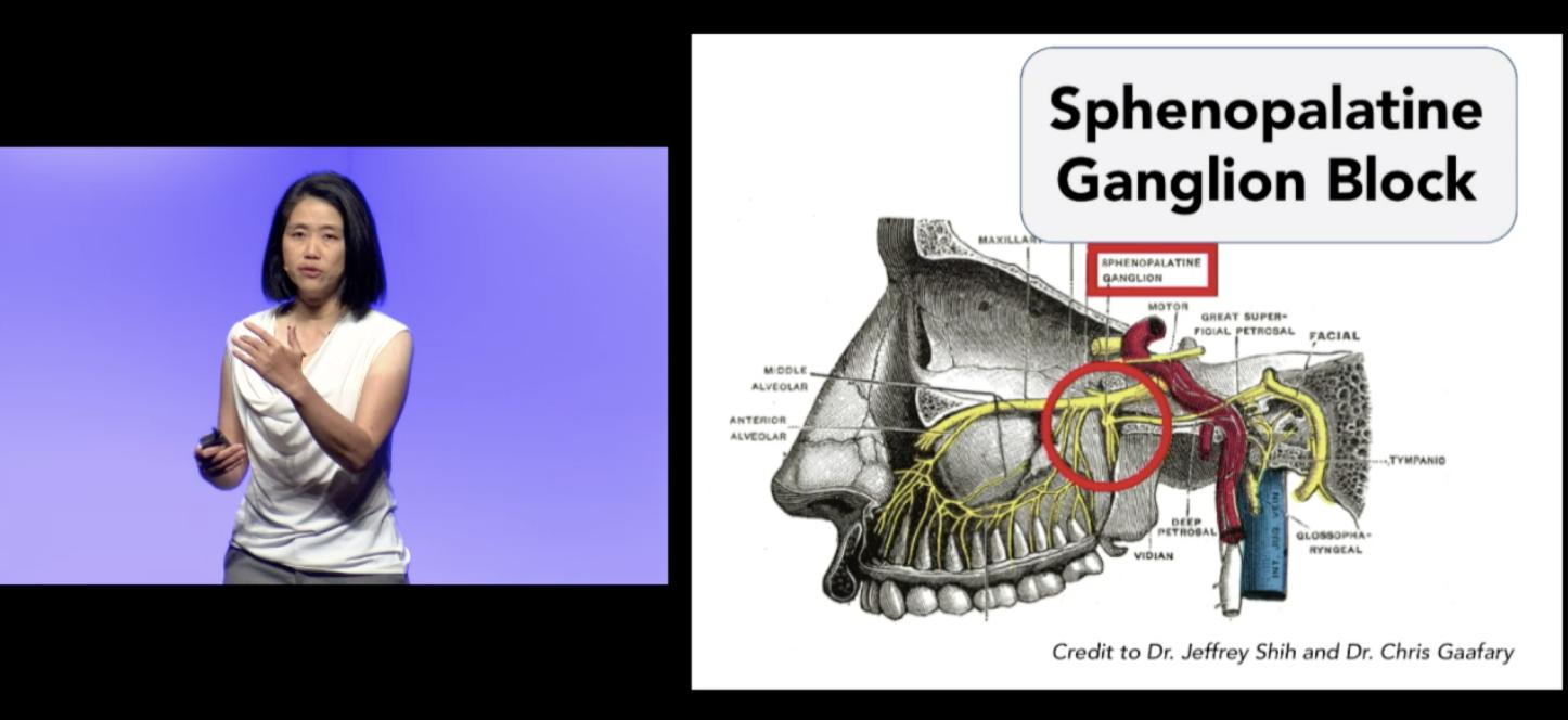 Sphenopalatine Ganglion Block Regen Doctors