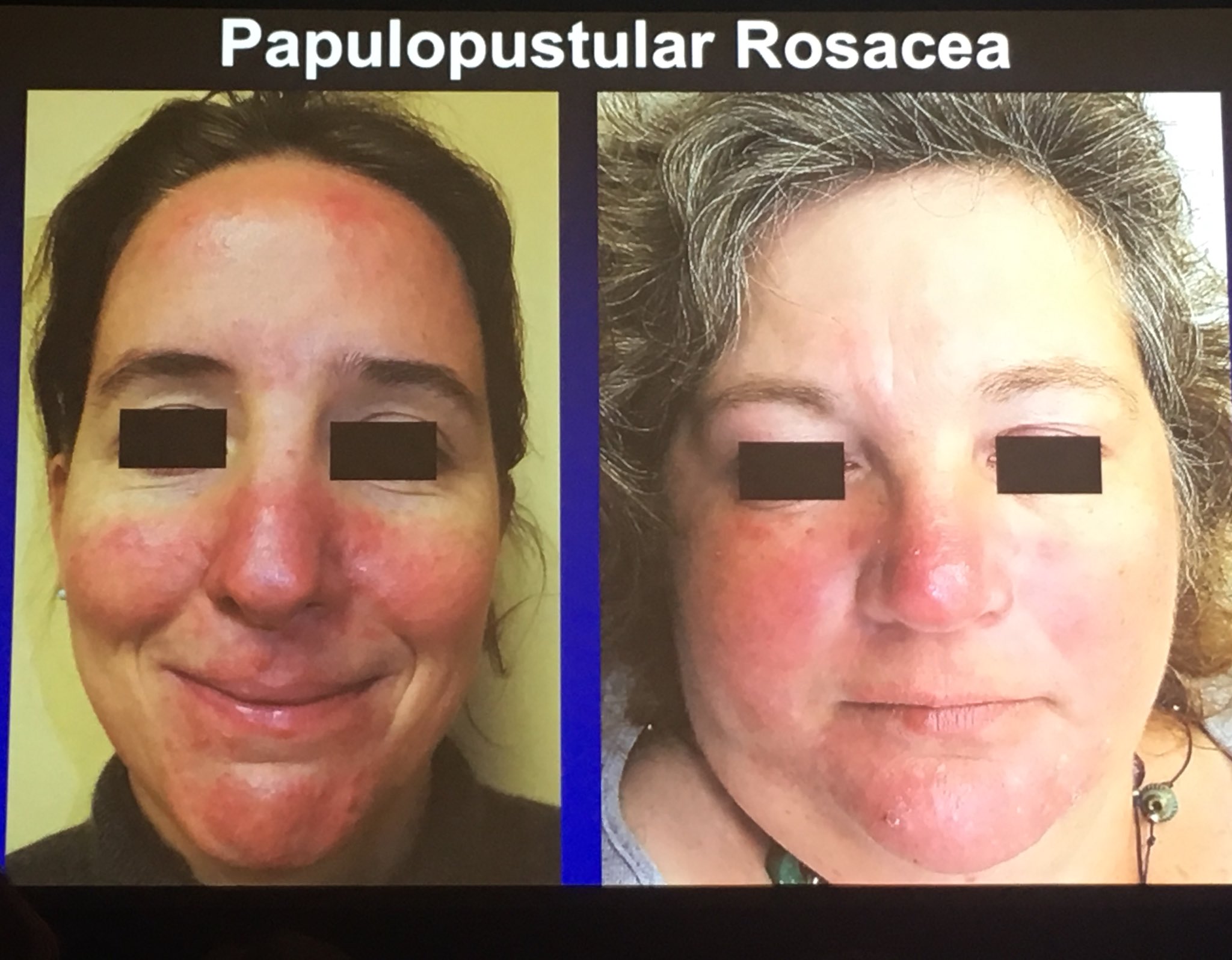 Difference Between Rosacea And Lupus