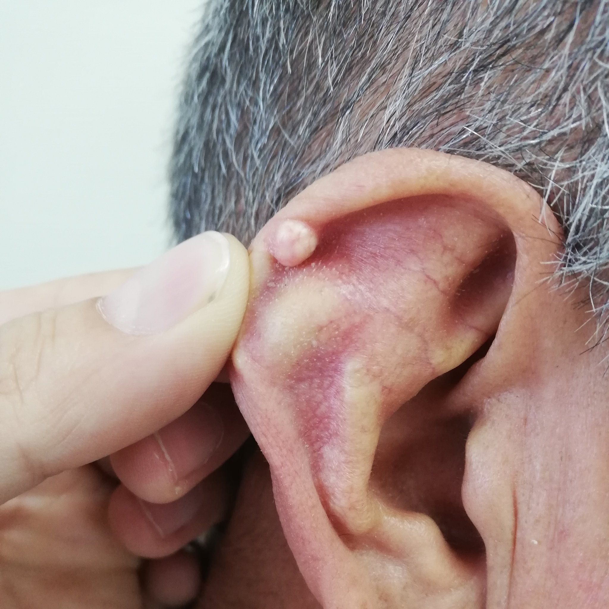 Tophus Ear