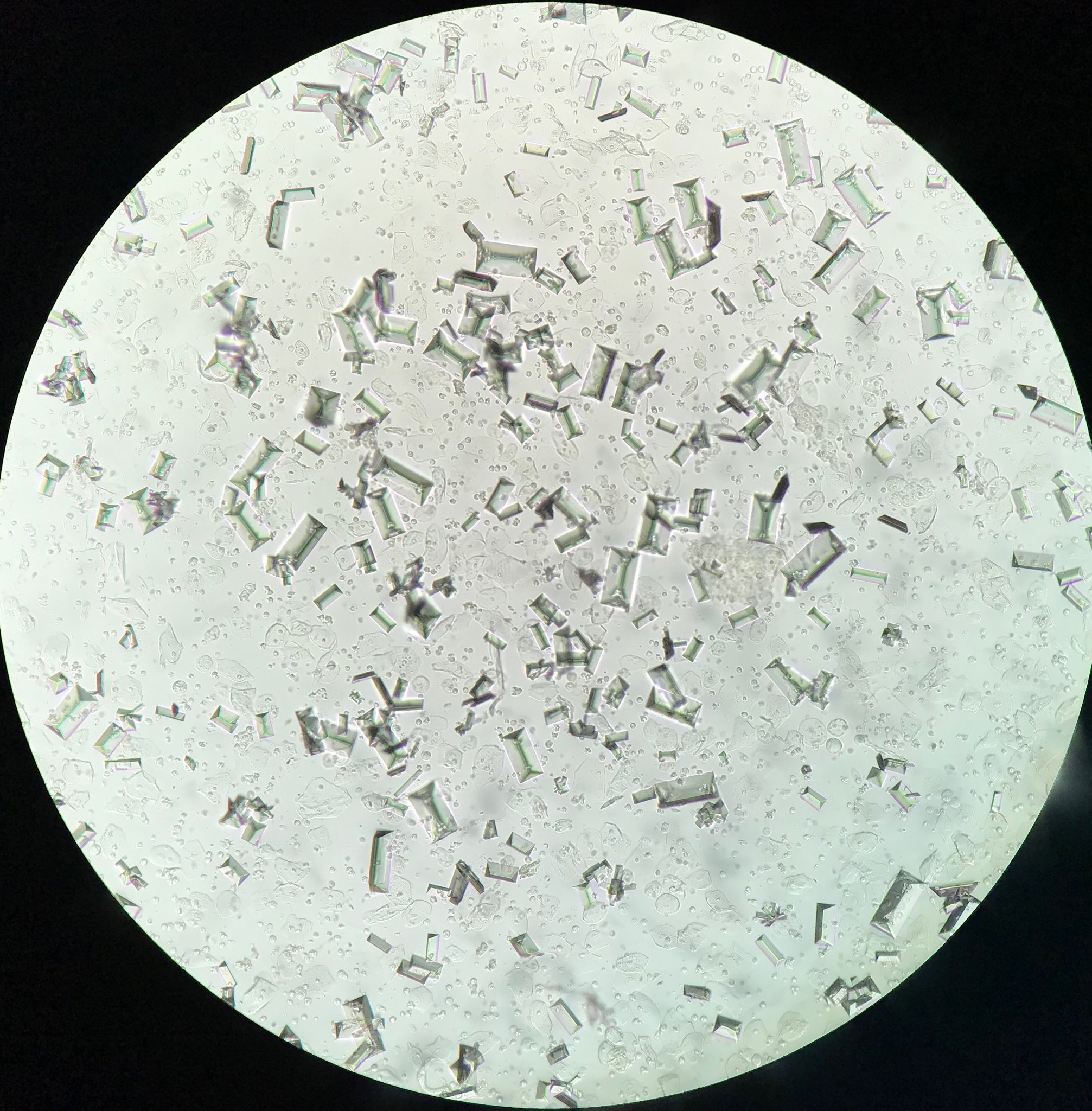 Squamous Epithelial Cells In Urine