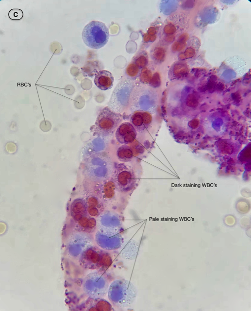 Urine Sediment Of The Month Waxy Casts Renal Fellow Network Urine