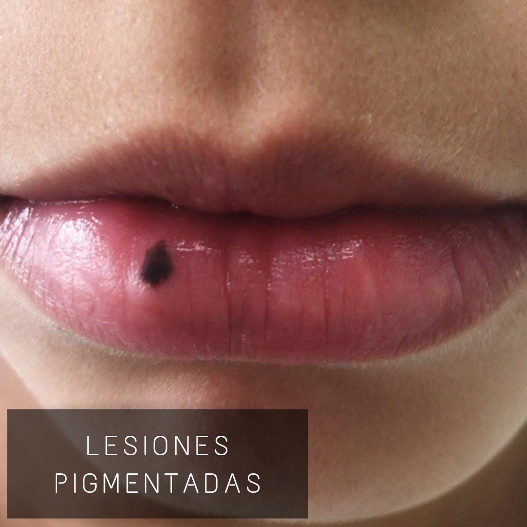 Restricción Método botella macula melanotica labial Sobretodo ... Restricción Método botella macula melanotica labial Sobretodo ...