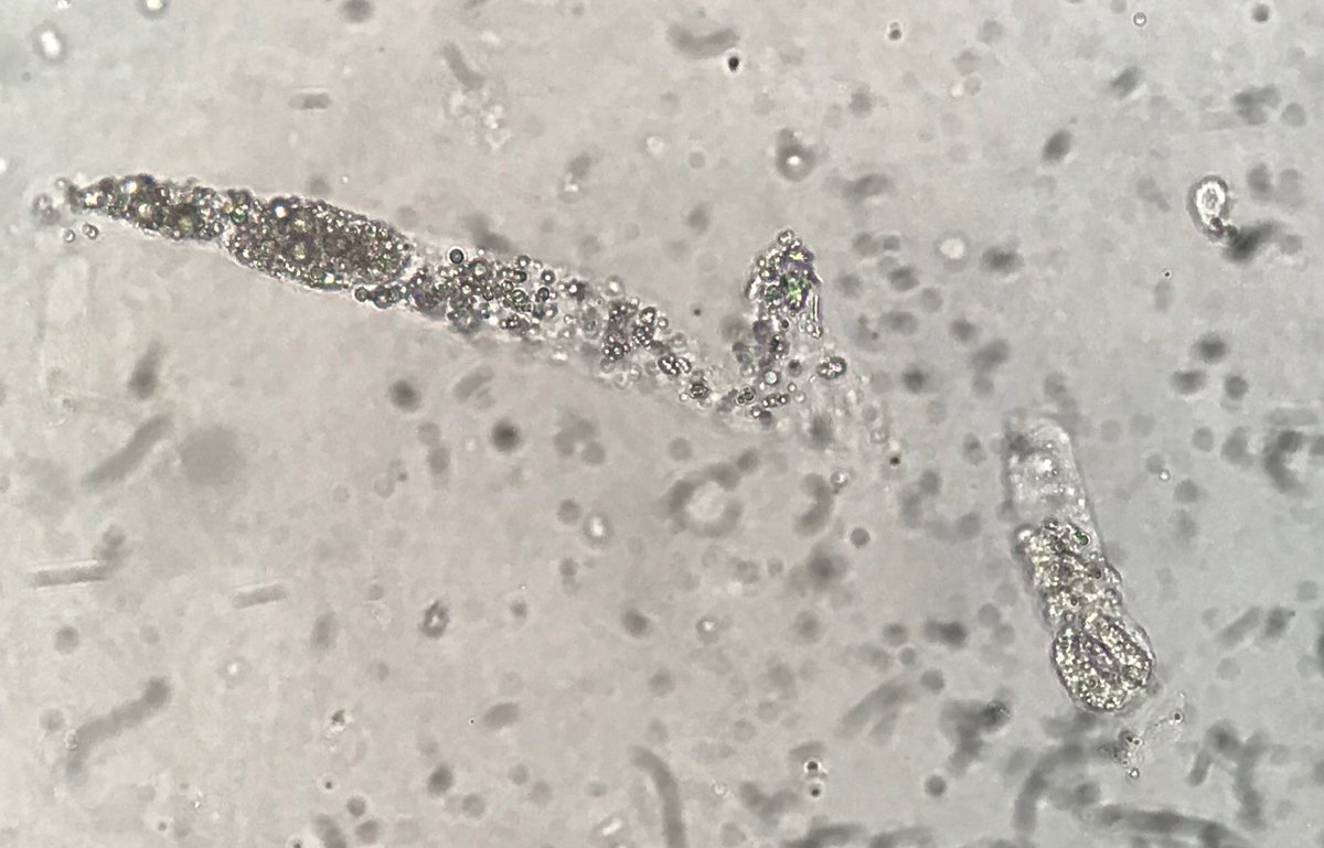 Fatty Casts In Urine