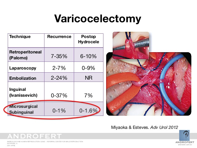Varicocelectomy Incision