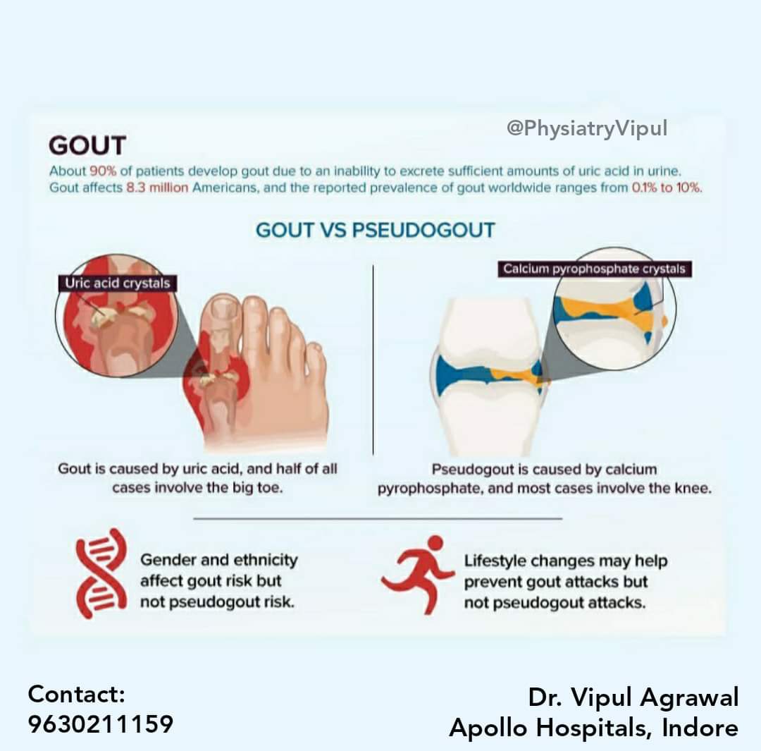 Pseudogout Arthritis