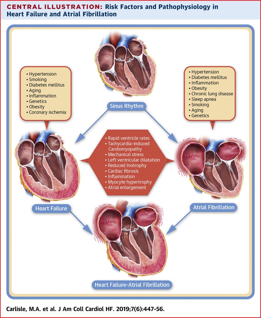 Atrial Fibrillation Pathophysiology