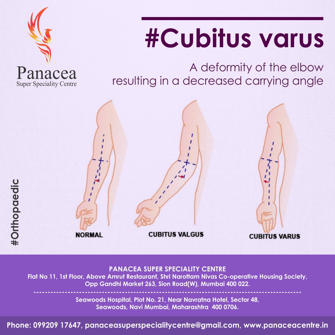 Cubitus Valgus And Cubitus Varus