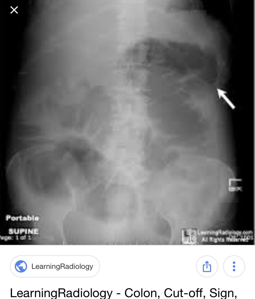 Colon Cutoff Sign