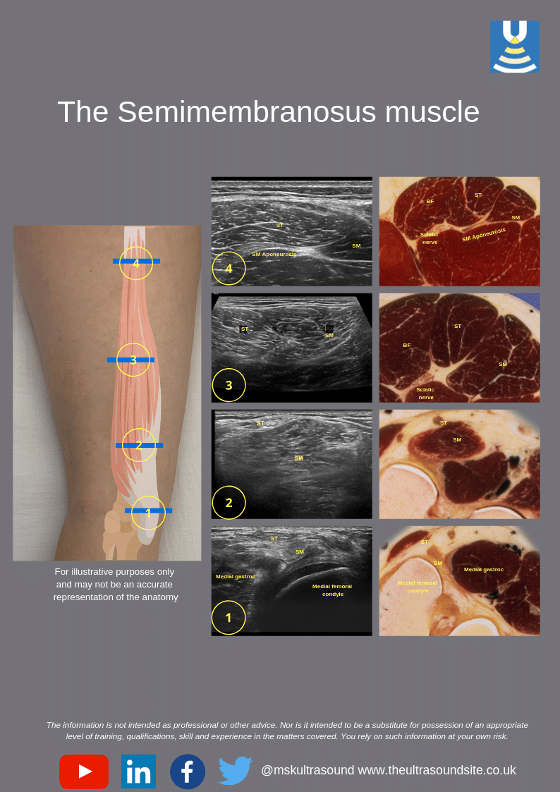 Ultrasound guided injections of the wrist and hand - The Ultrasound Site