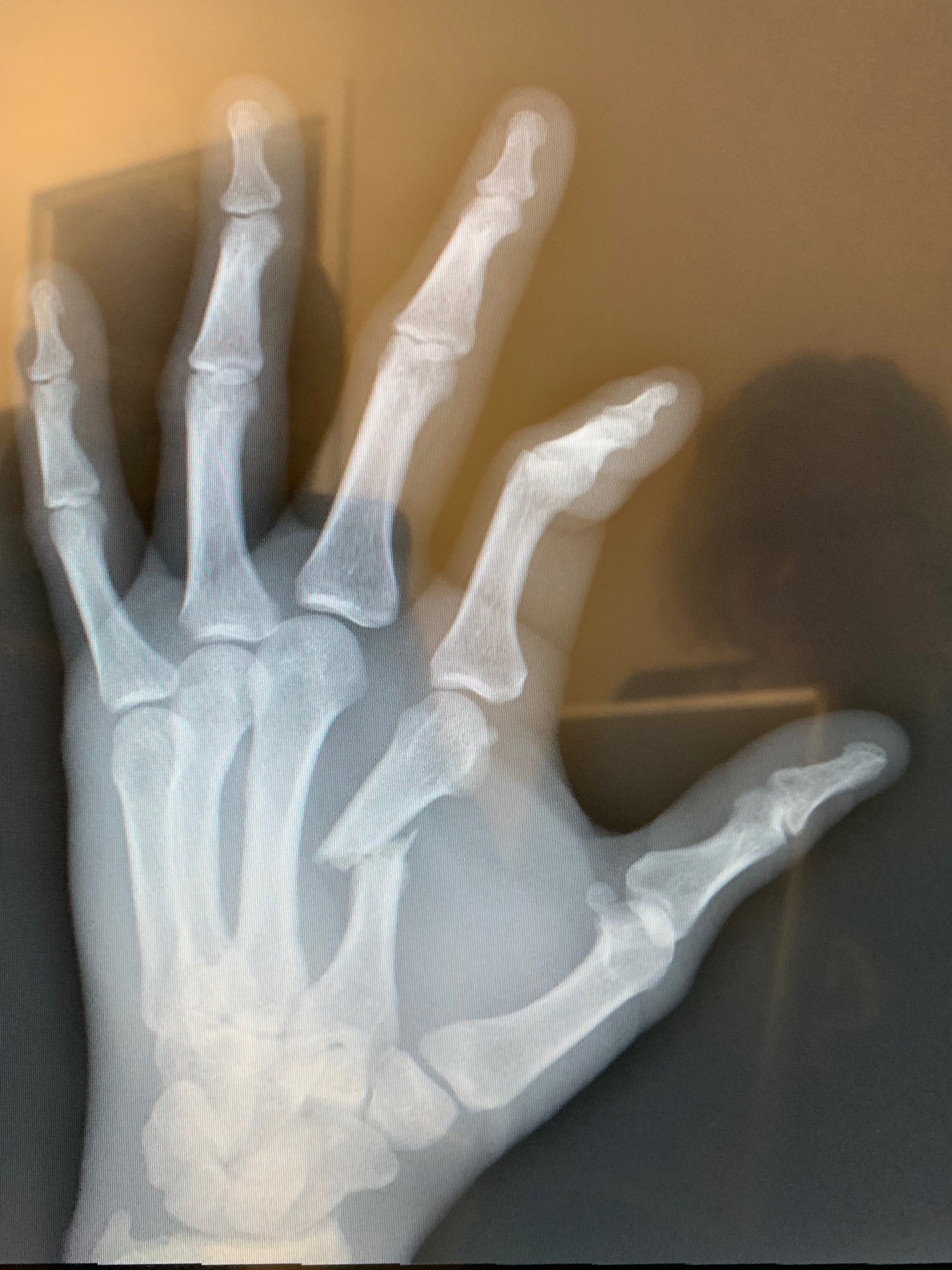 Broken Hand X Ray