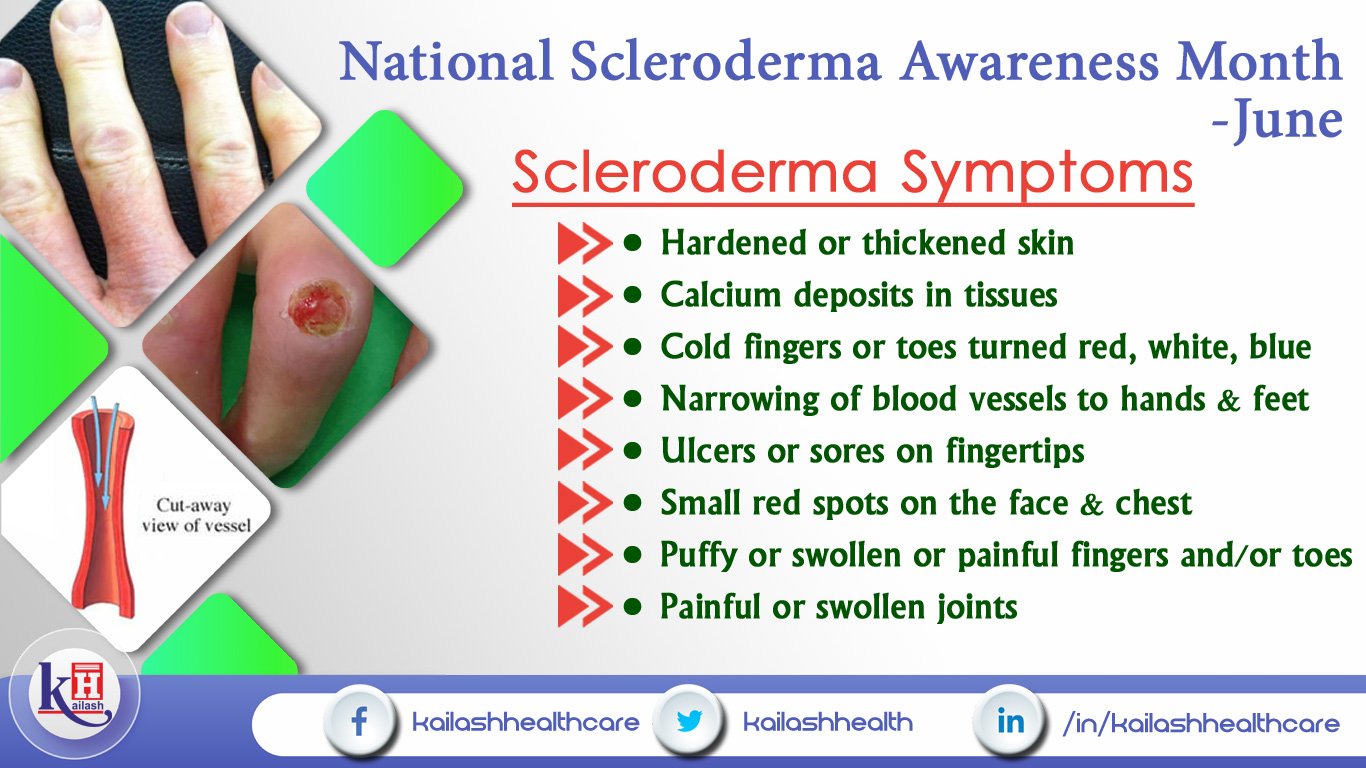 Scleroderma Skin Symptoms