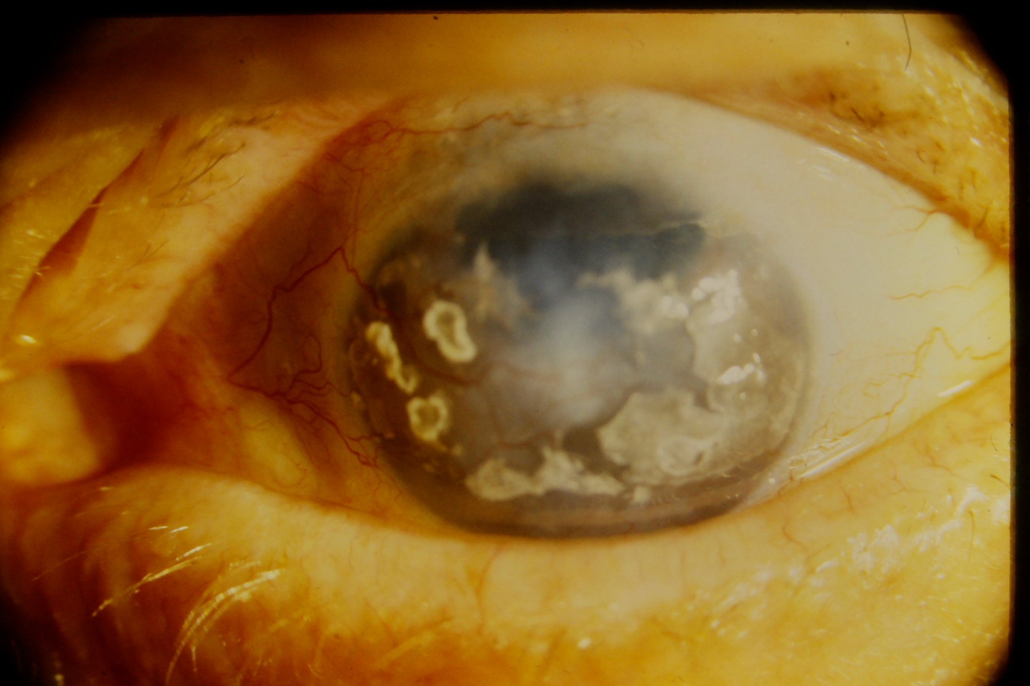 Severe Band Keratopathy