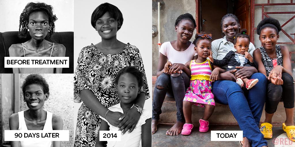 Pictures Of People With Aids Before And After