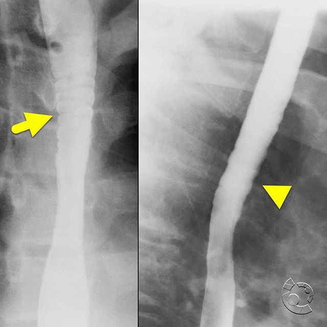 Eosinophilic Esophagitis Barium Swallow