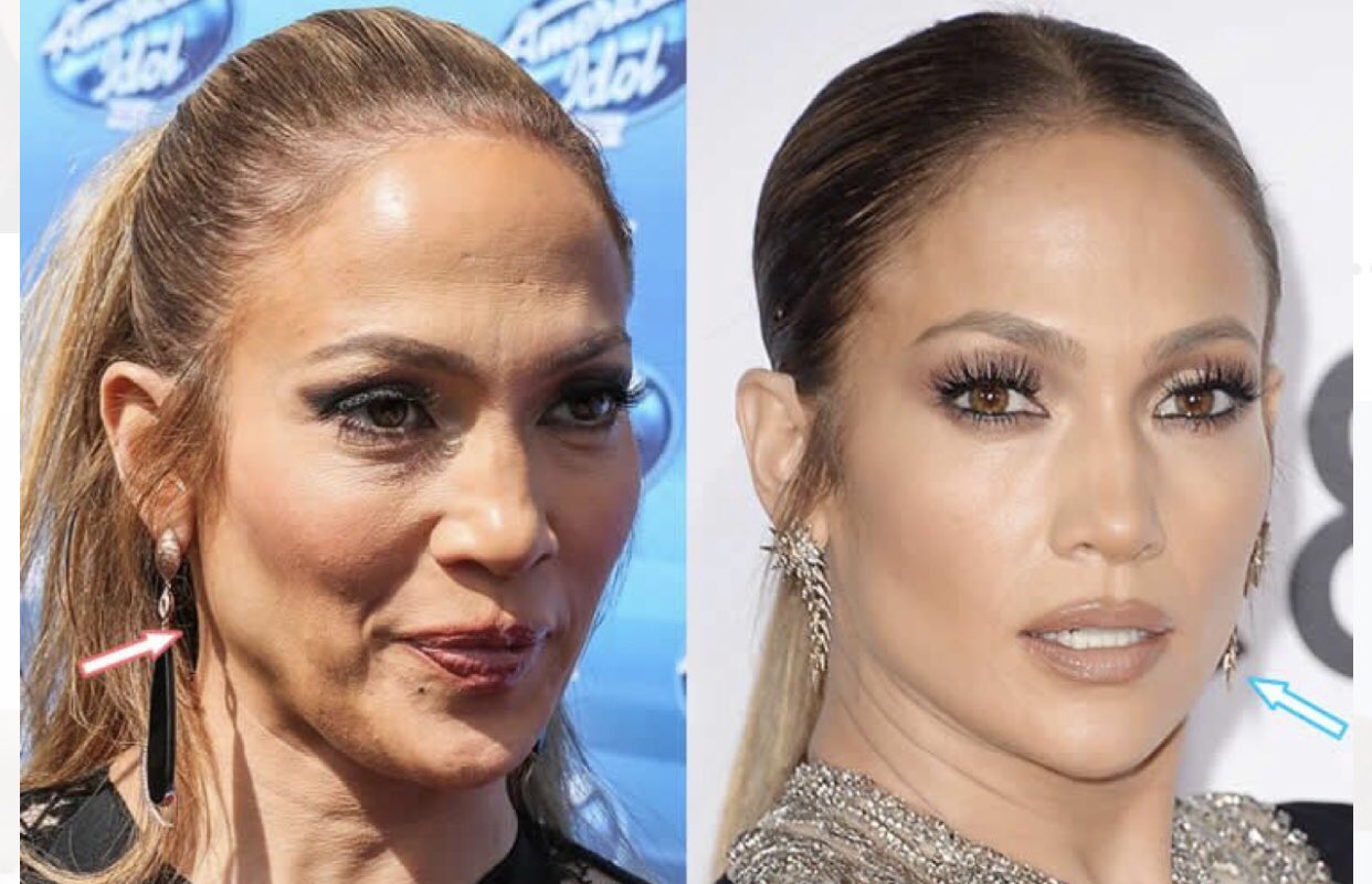 Botox Before And After Celebrity