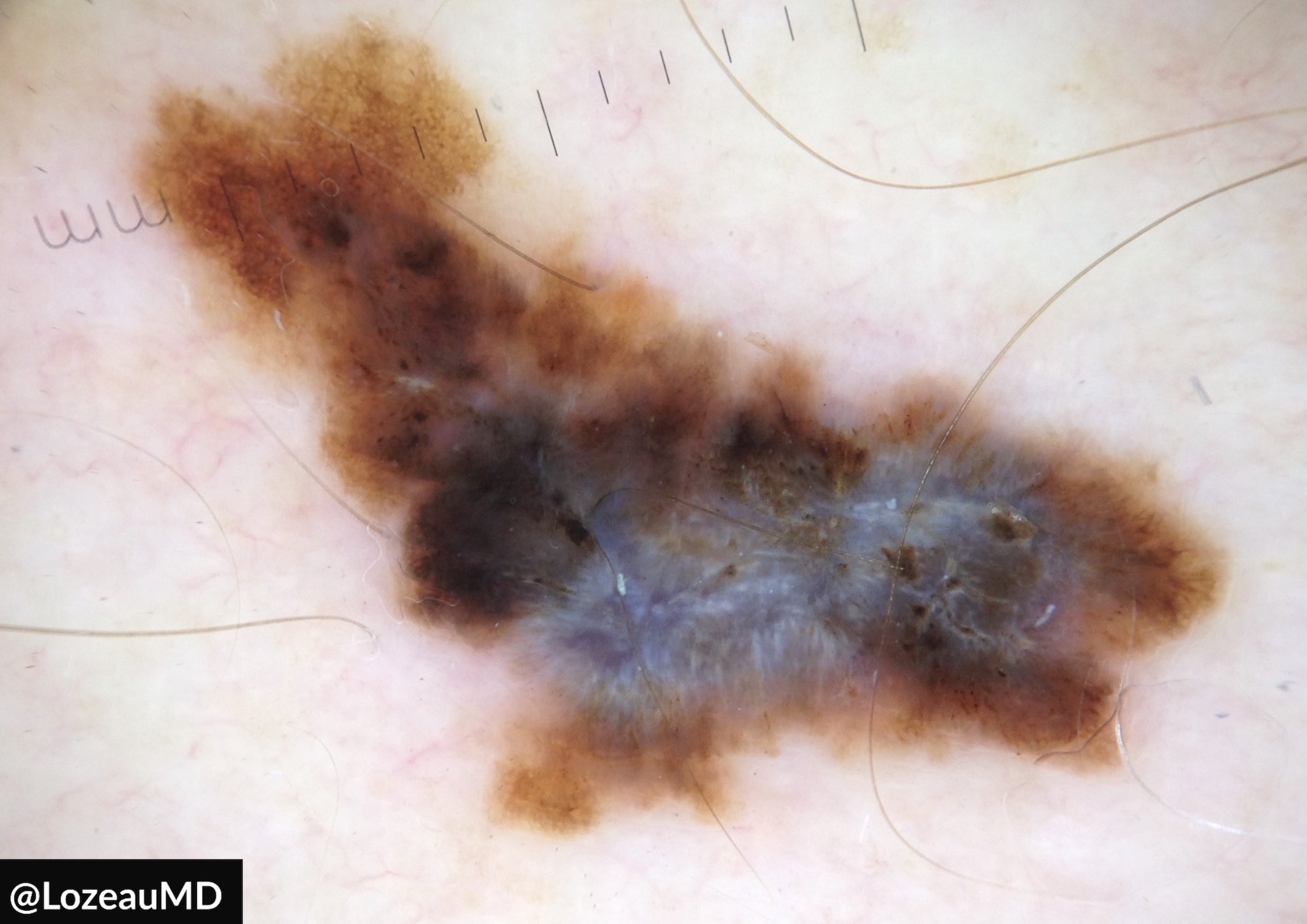 Melanoma Dermoscopy