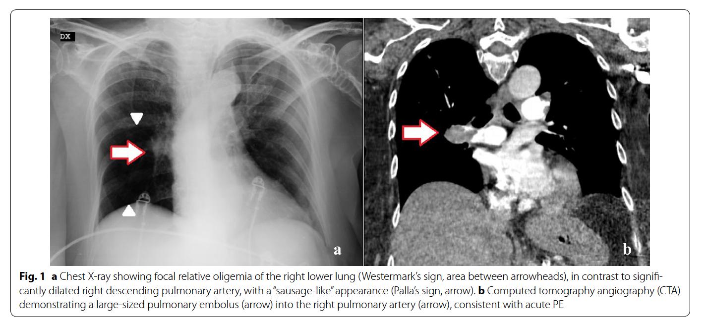 Pulmonary Embolism Chest X Ray