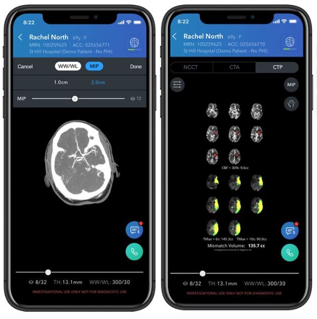 IFC on Twitter: "Faster treatment makes a difference for stroke victims. AI-based technology ...