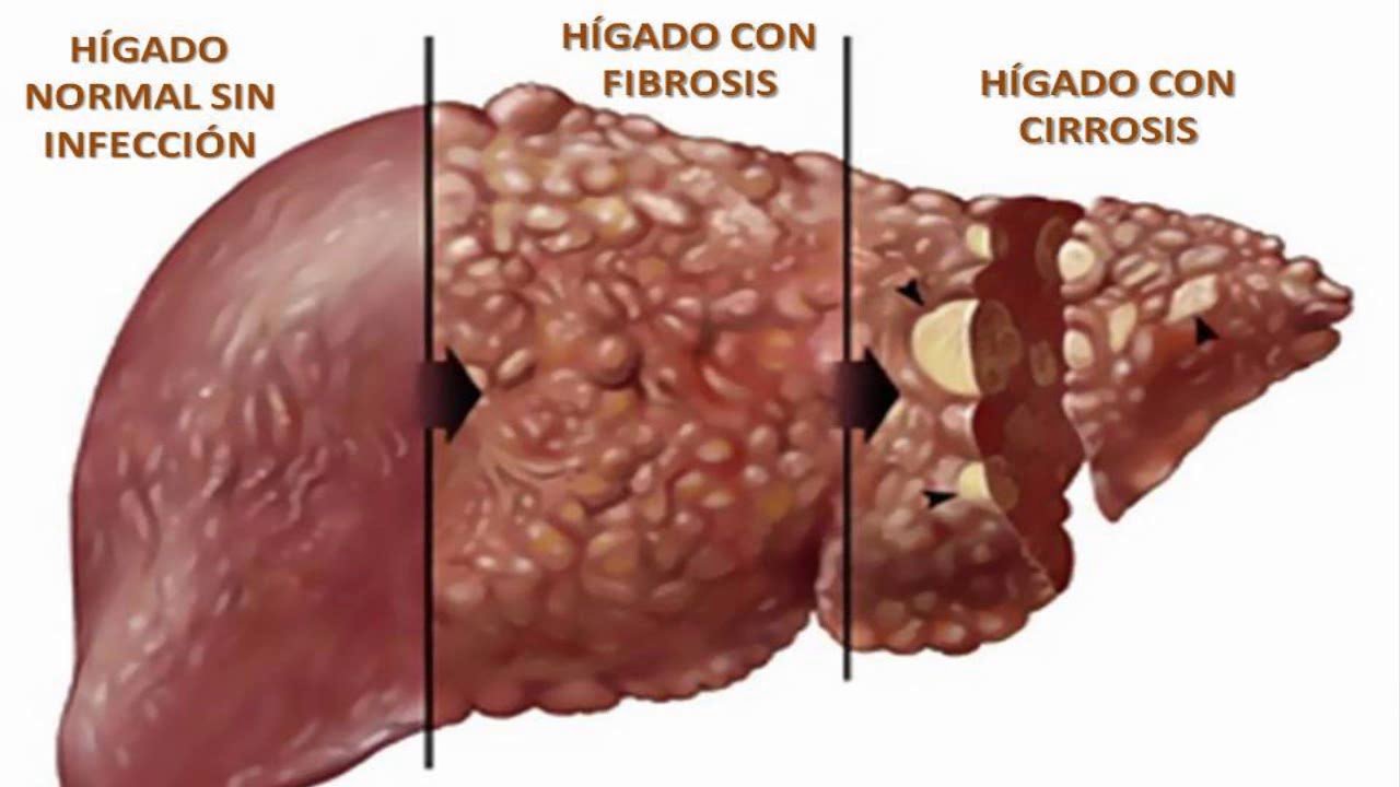 Hígado Afectado Por El Alcohol Antes Y Después