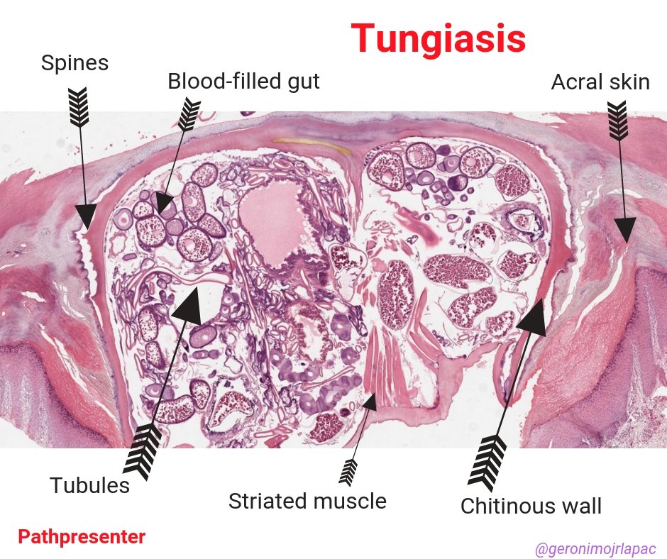Tunga Penetrans Histology