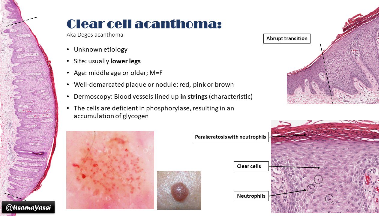 Clear Cell Acanthoma Dermoscopy