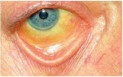 Scleral Icterus