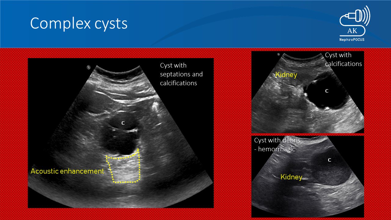 Renal Cyst Ultrasound