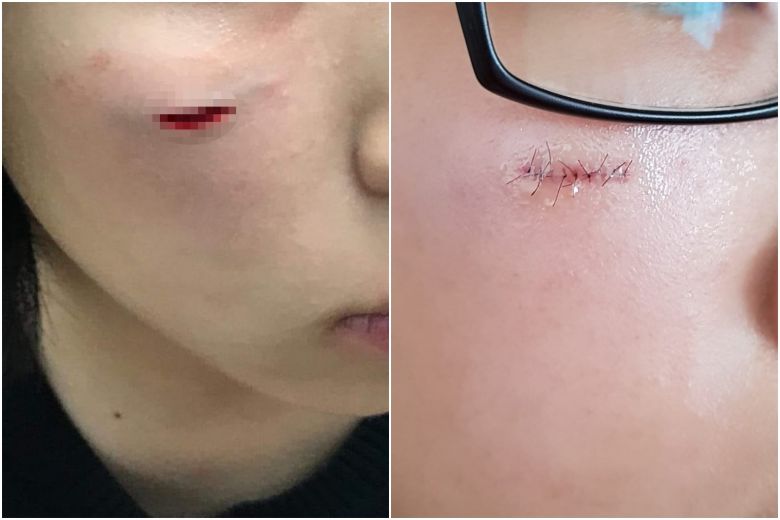 Before And After Stitches
