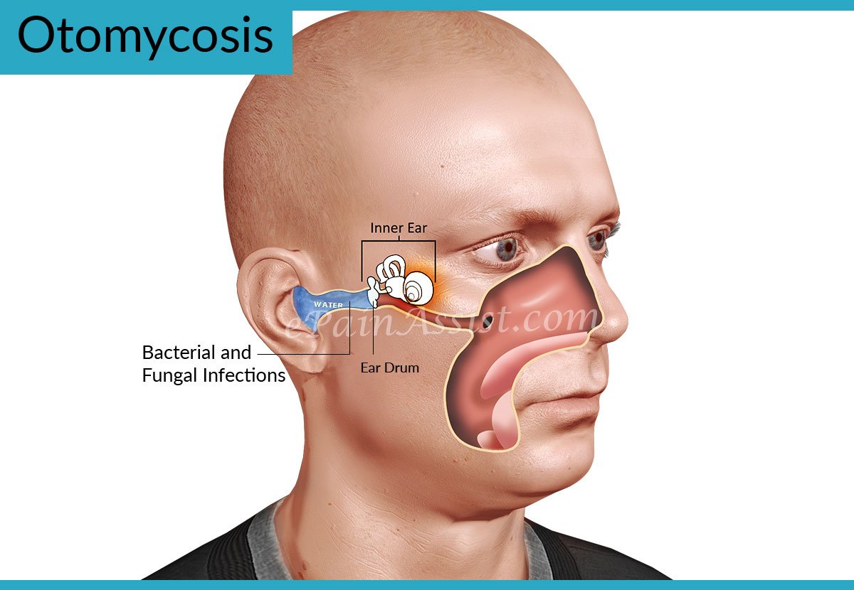 Otomycosis Fungal Infection Of The Ear Canal Dr