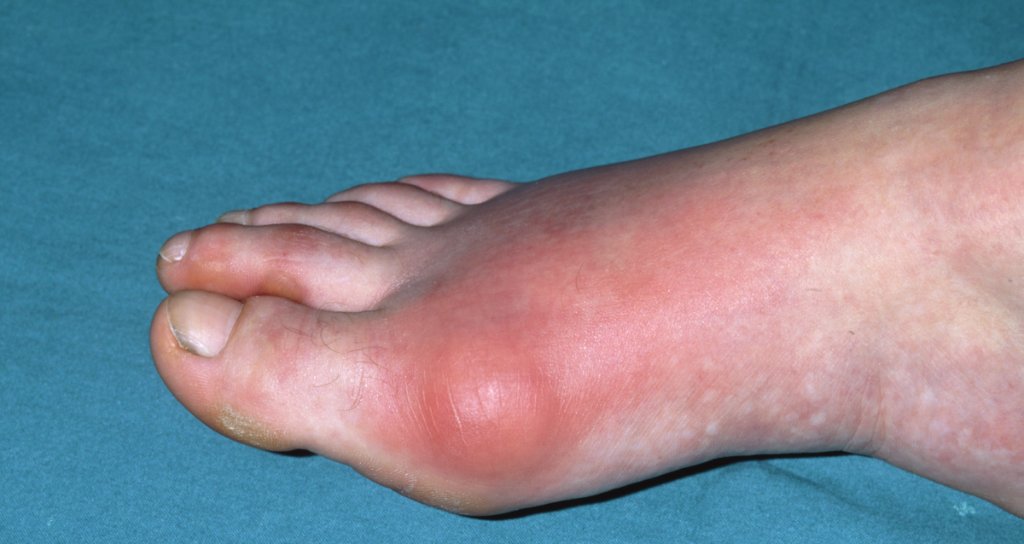 The most common sign of gout is a nighttime attack of swelling ...