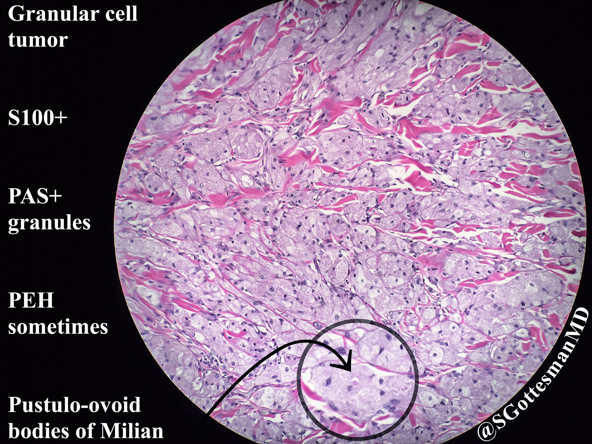 Granular Cell Tumor Histology