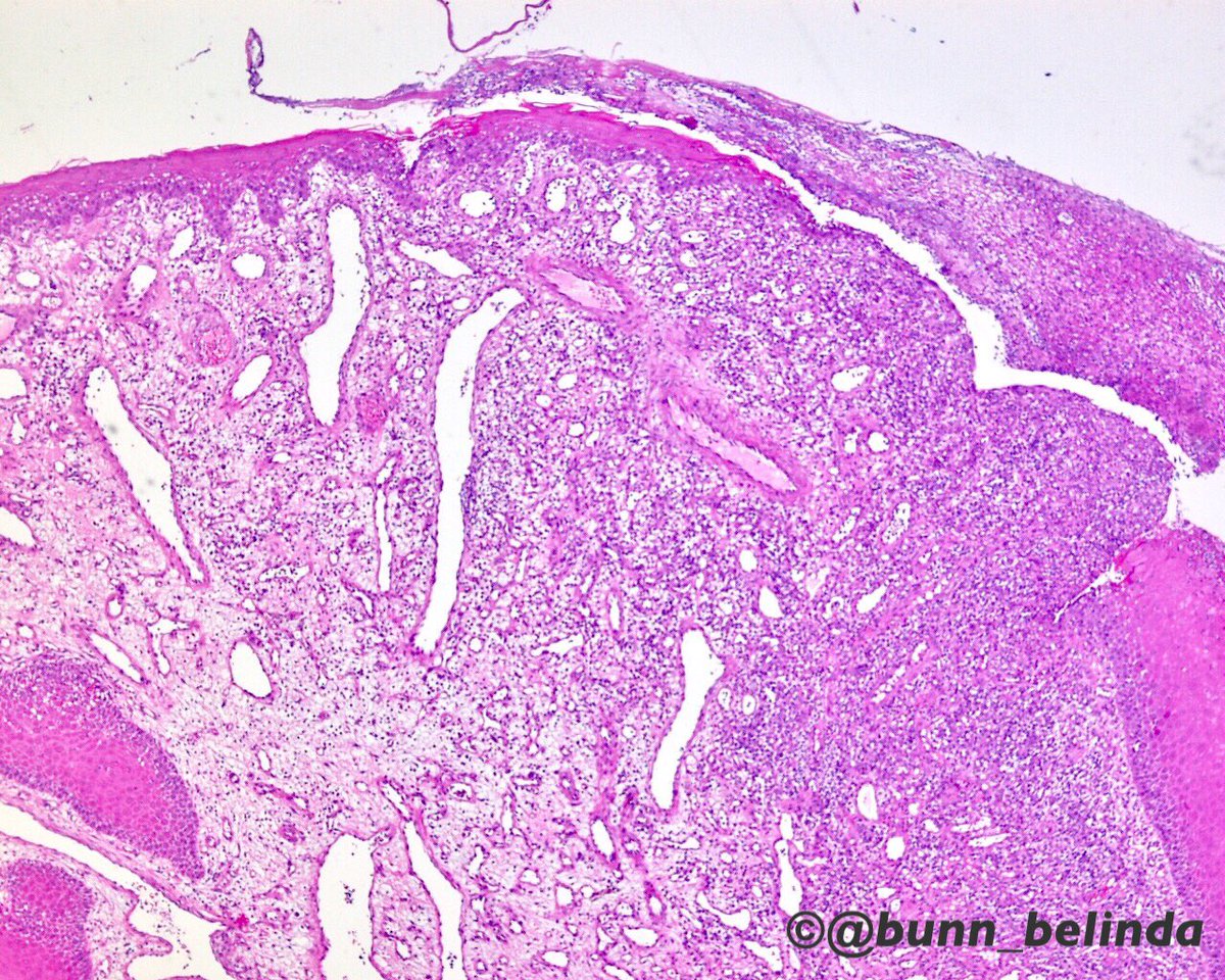 Pyogenic Granuloma Histology
