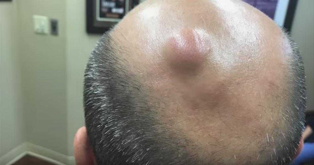 Scalp Pimple Pop