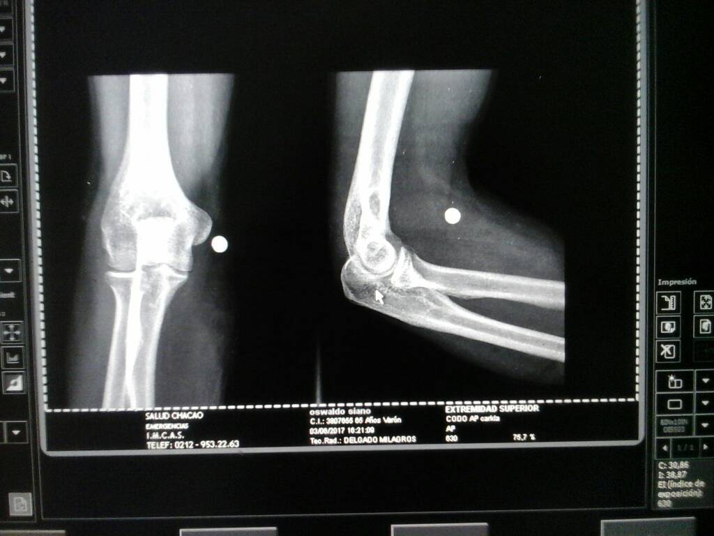 Radiografía del brazo derecho de Oswaldo Siano. La imagen es la de un balín disparado hoy por la ...