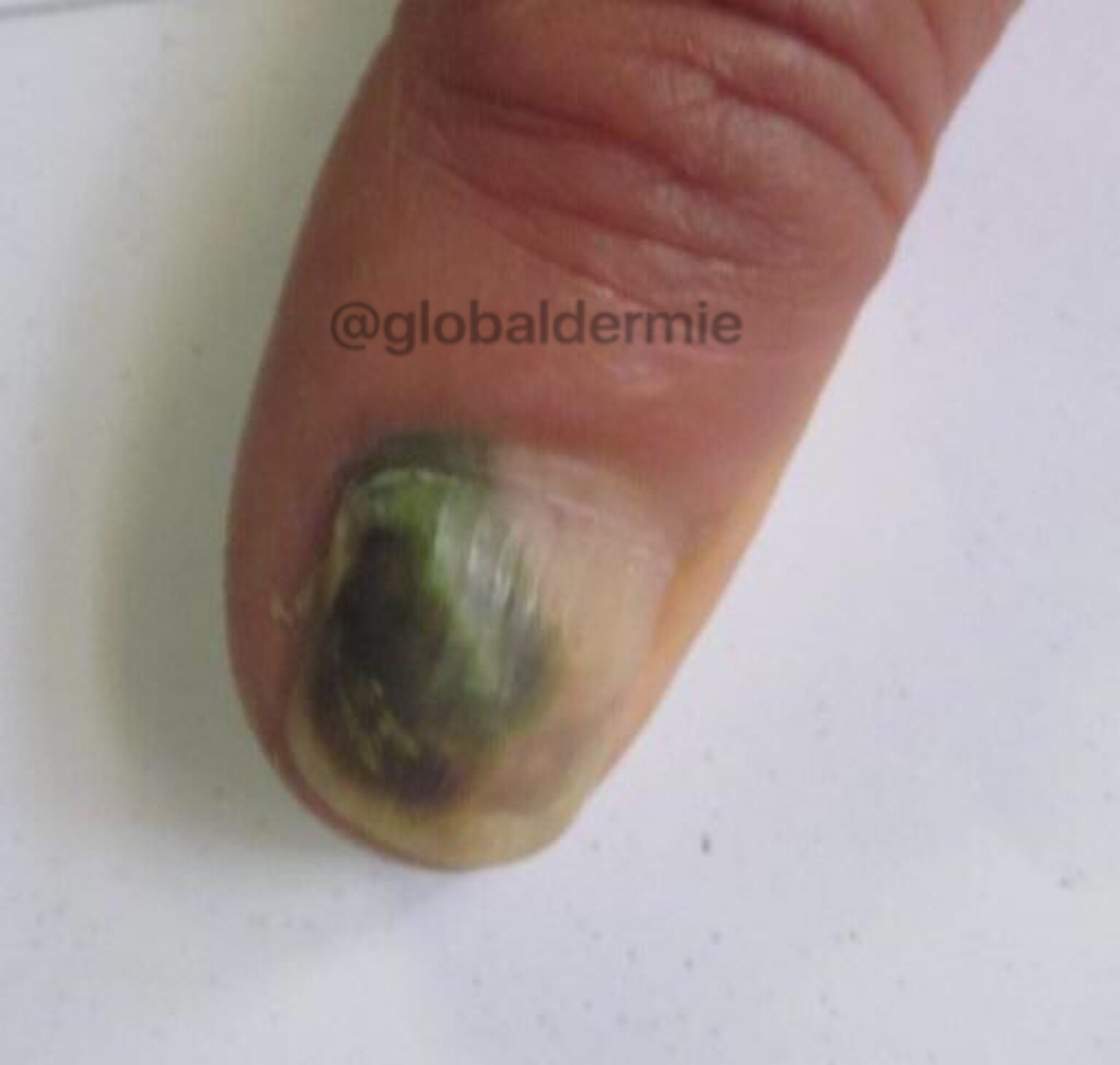 Pseudomonas Nail