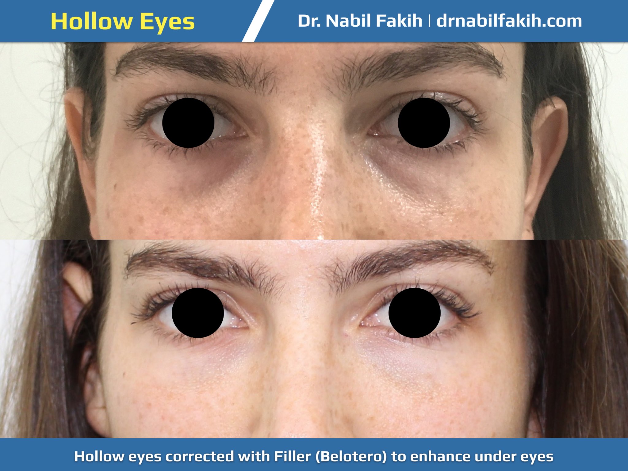 Belotero Before And After Under Eyes
