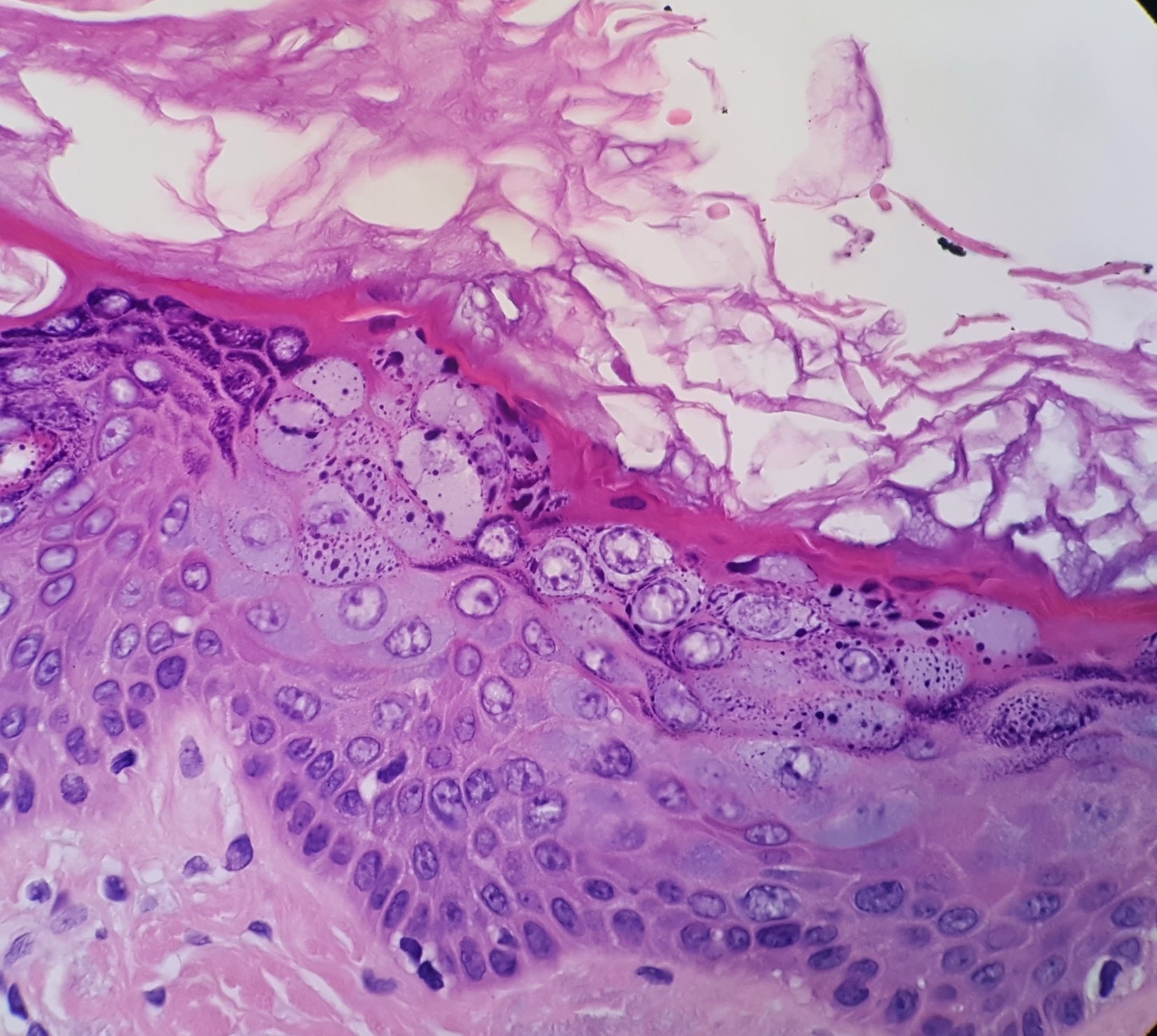 Epidermodysplasia Verruciformis Histology Sebaceous Cell Carcinoma