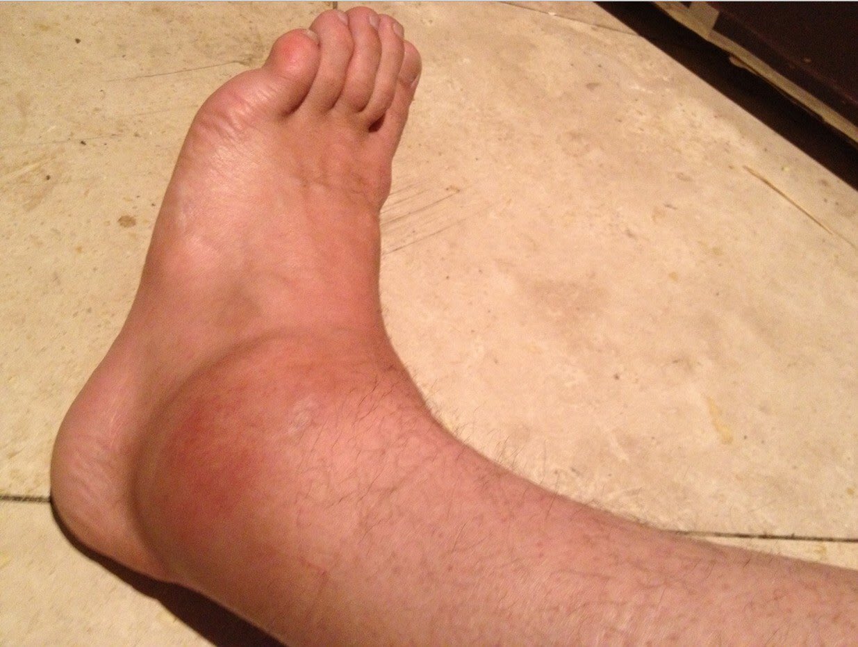 Soft Tissue Inflammation Soft Tissue Laser Therapy — Relief Podiatry