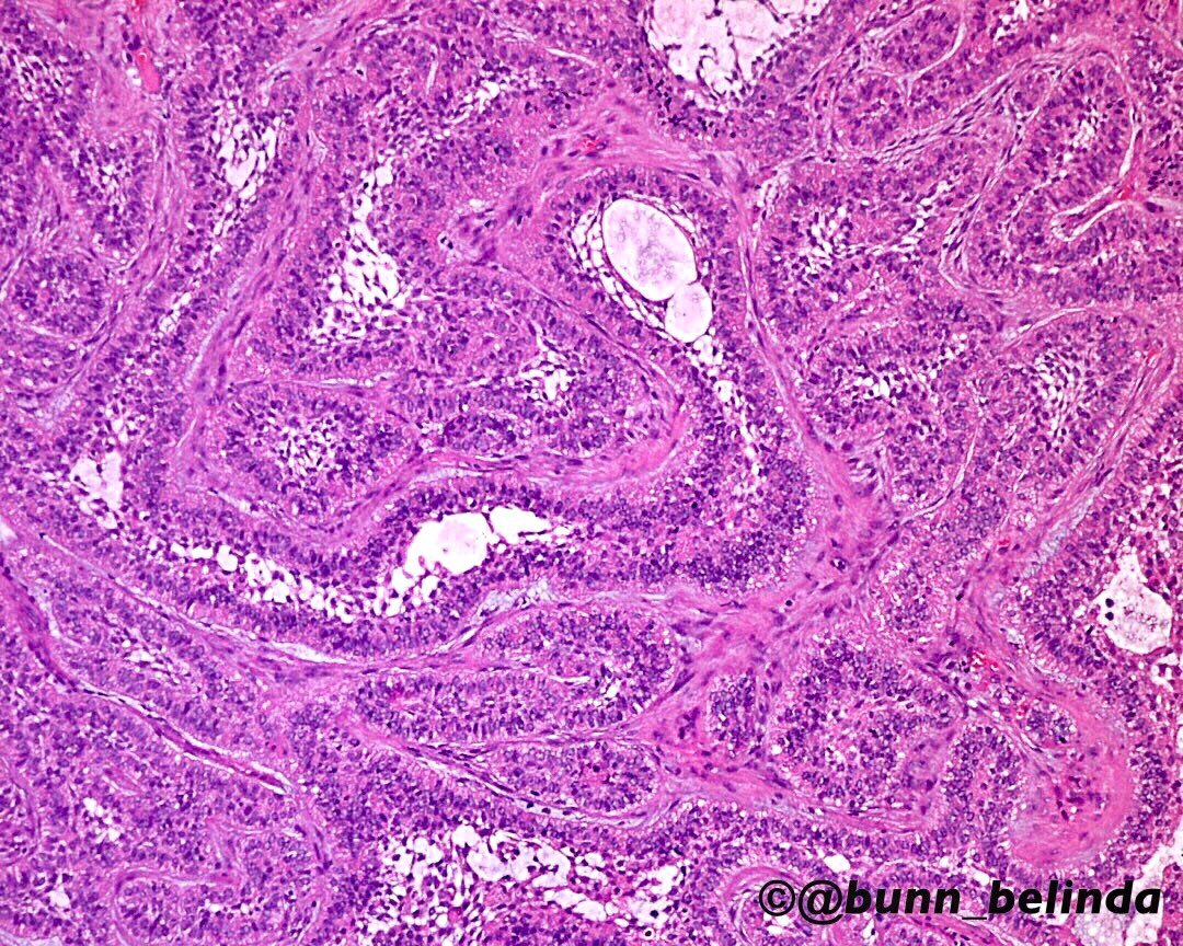 Plexiform Ameloblastoma Histology