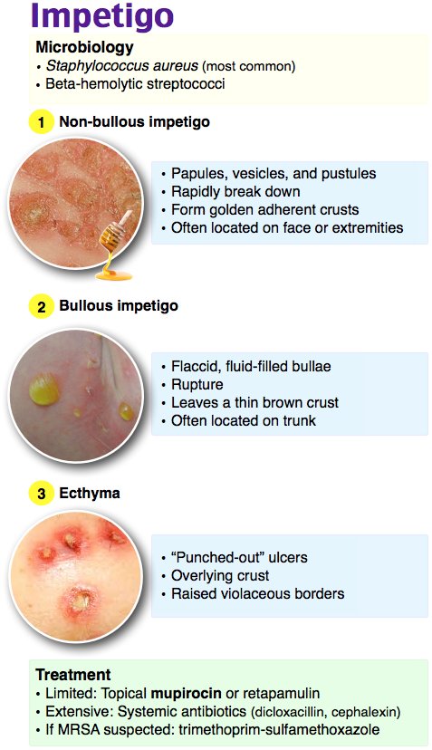 Ecthyma Impetigo