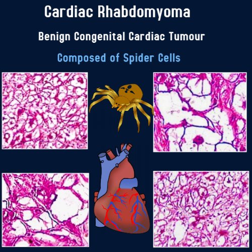 Cardiac Rhabdomyoma