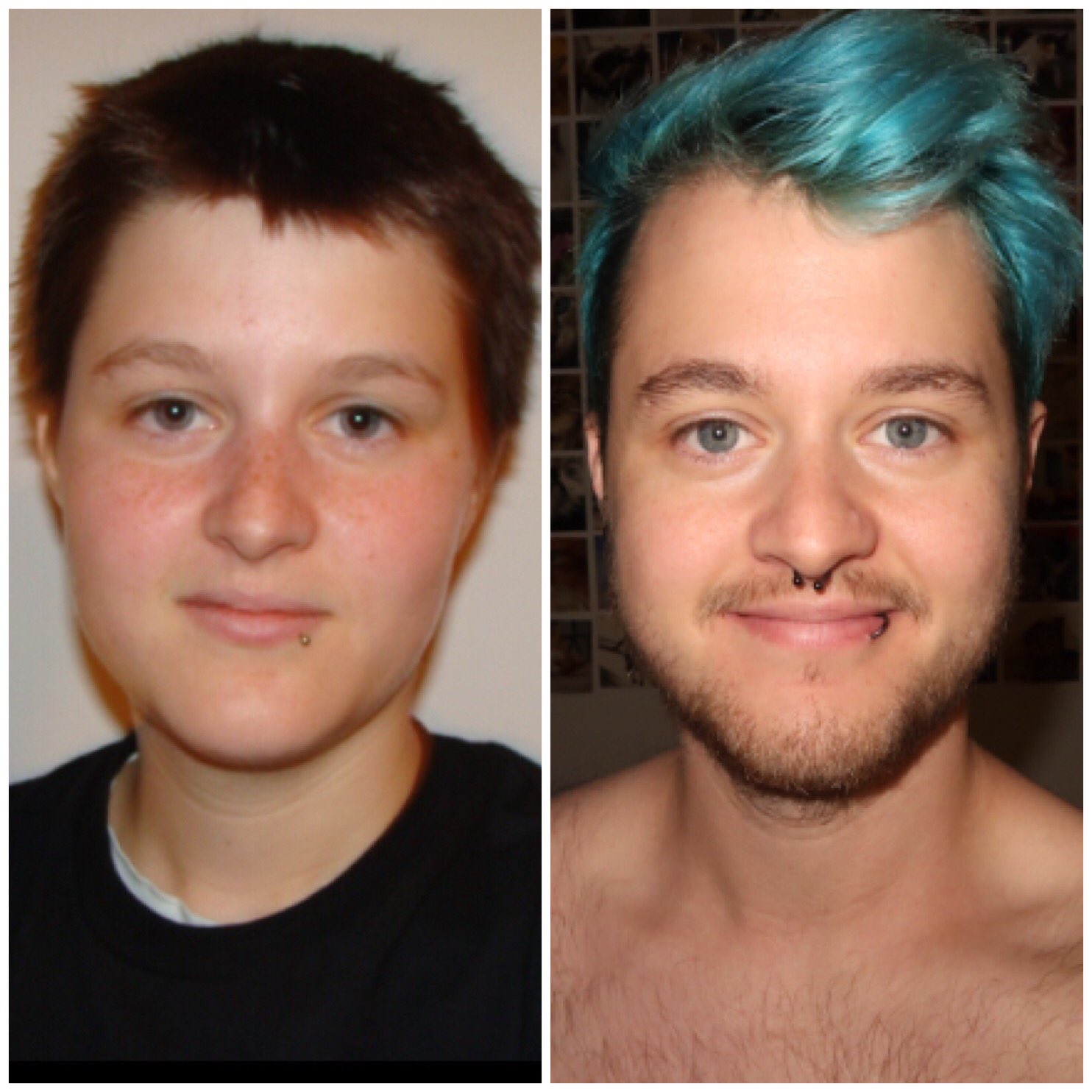 Ftm Before And After Face