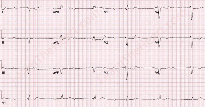 Third Degree Av Block Ecg