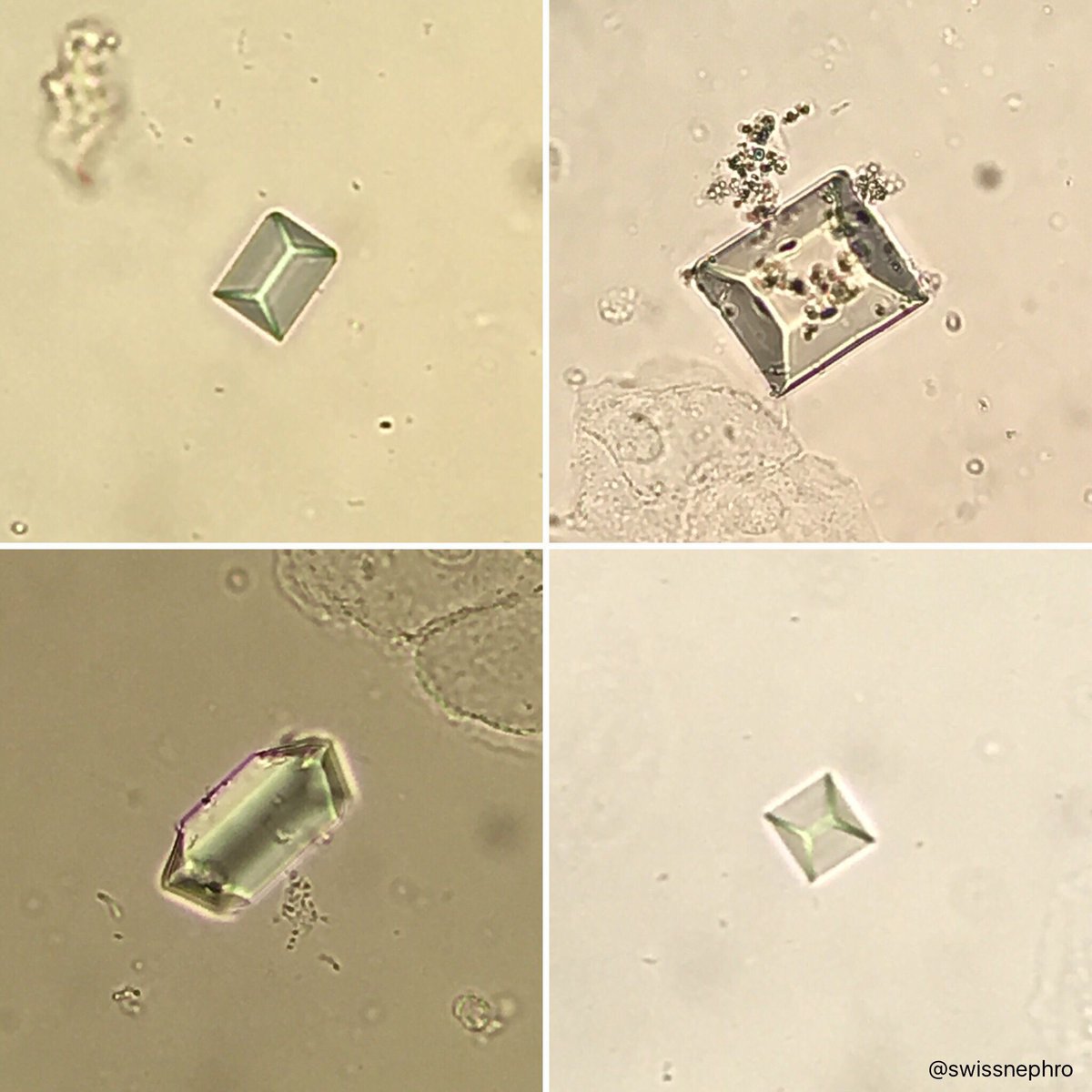 Triple Phosphate Crystals In Urine